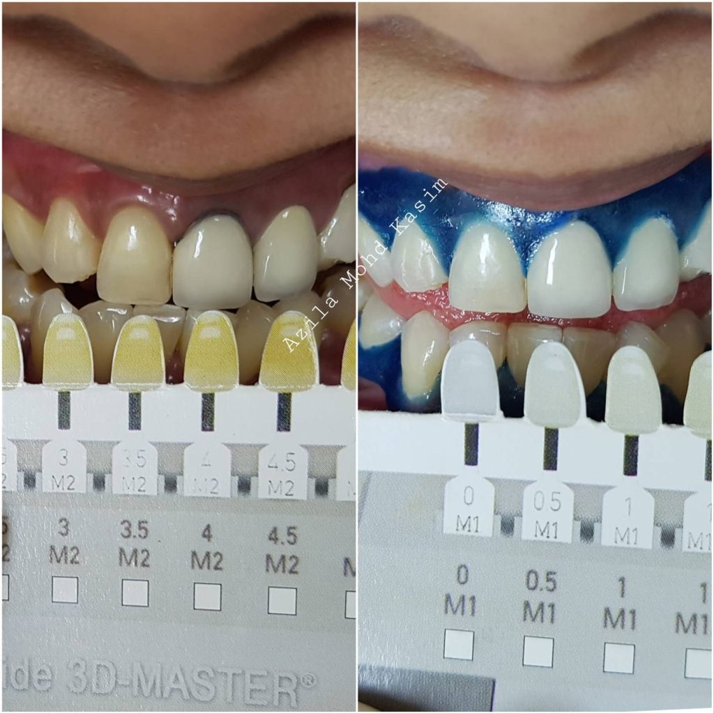 Ubat Gigi Sumber Arang Boleh Putihkan Gigi? Doktor Ini Kongsikan Faktanya