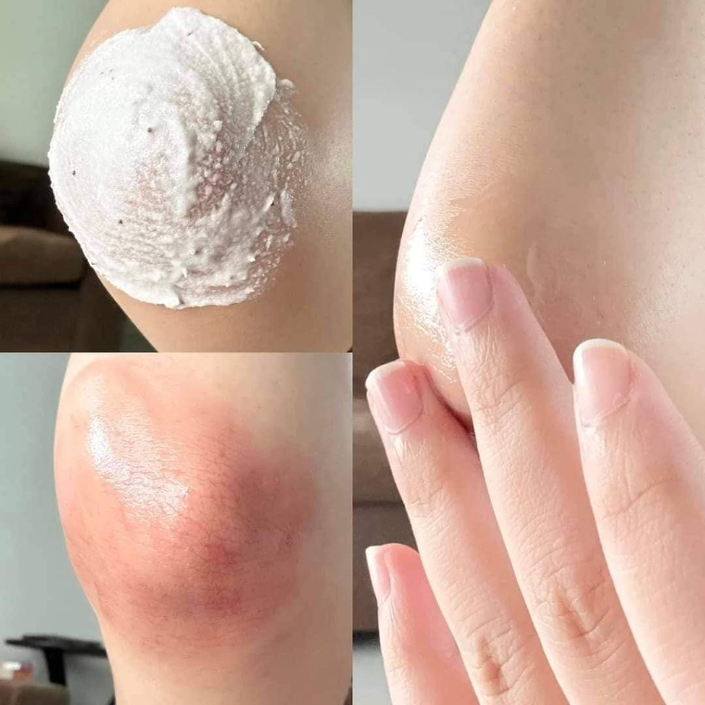 Begini Cara Atasi Masalah Siku & Lutut Hitam, Konsisten Buat, Hasil ...